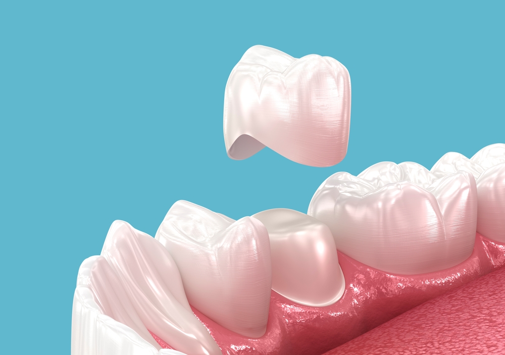 What to Do When a Dental Crowns Comes Loose | PGA Dentistry